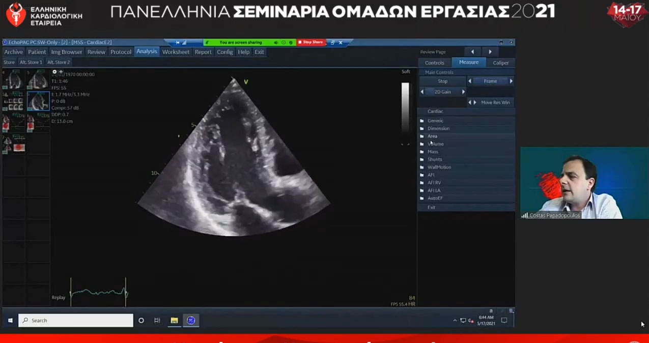 Μυοκαρδιακή παραμόρφωση / έργο Αριστερής κοιλίας • ΚΩΝΣΤΑΝΤΙΝΟΣ Χ ...