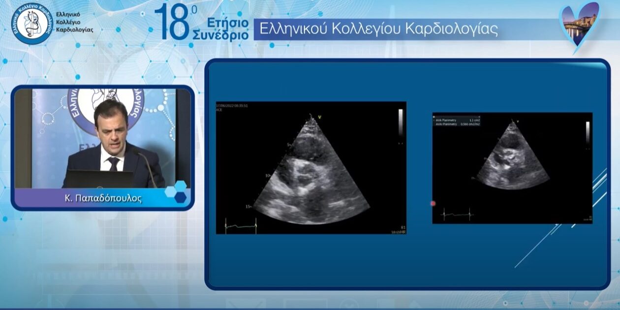 Στένωση της αορτής με φυσιολογικό κλάσμα εξώθησης και χαμηλή κλίση ...