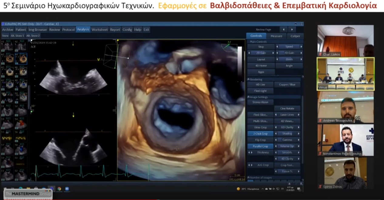 Β. Τριδιάστατη απεικόνιση και εκτίμηση μιτροειδούς βαλβίδας Κ.Γ ...